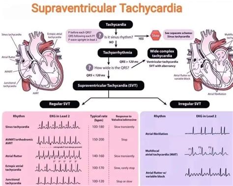 Supraventricular Tachycardia Medizzy