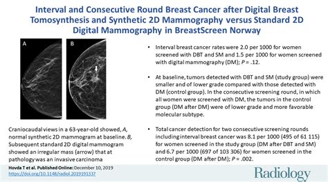 Interval And Consecutive Round Breast Cancer After Digital Breast Tomosynthesis And Synthetic 2d