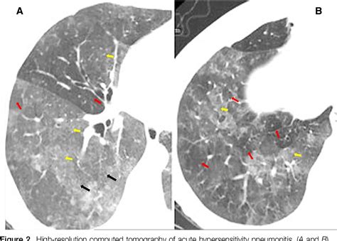 Acute Hypersensitivity Pneumonitis