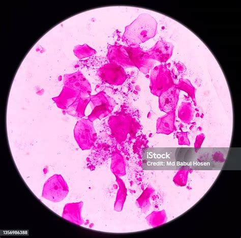 그램 얼룩 현미경 슬라이드 충분한 상피 세포 몇 고름 세포 디플로코치와 곰팡이 최면 건강관리와 의술에 대한 스톡 사진 및 기타 이미지 건강관리와 의술 과학 과학