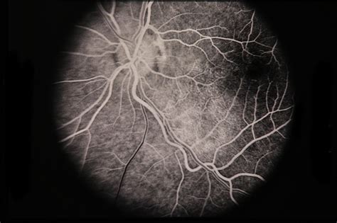 Choroidal Hemangioma Retina Image Bank Choroidal Hemangioma Retina Image Bank