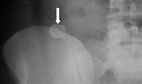 Figure 1 From Ruptured Acute Appendicitis With Calcified Appendicolith