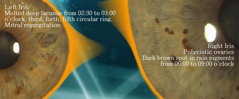 Iris Patterns Slide 4 A Iris Patterns