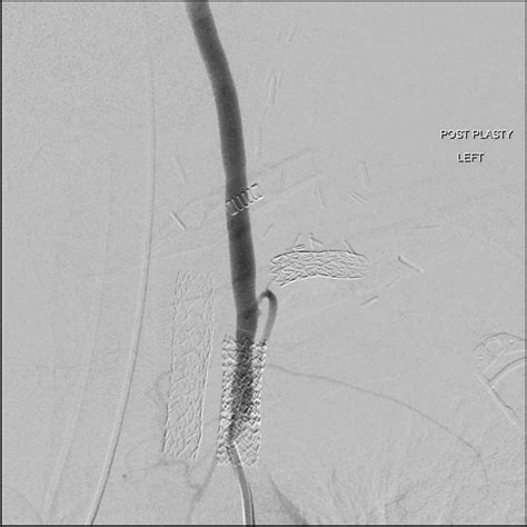 Cholangiocarcinoma Radiopaedia Cholangiocarcinoma Radiology Case