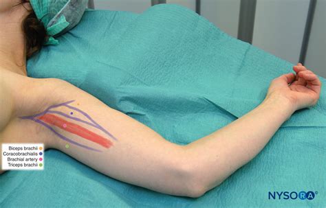 Axillary Brachial Plexus Block Landmarks And Nerve Stimulator Technique NYSORA