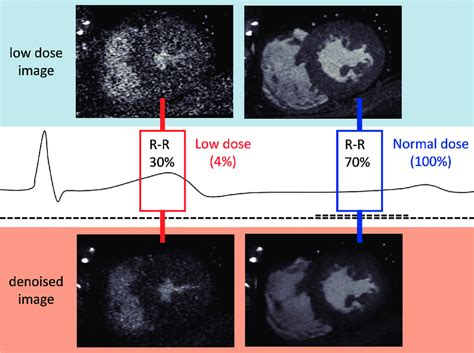 Image Noise Reduction By Artificial Intelligence In Multiphase Cardiac Download Scientific