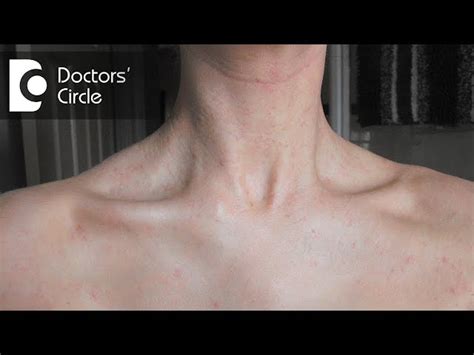 Red Rash Spot On Neck