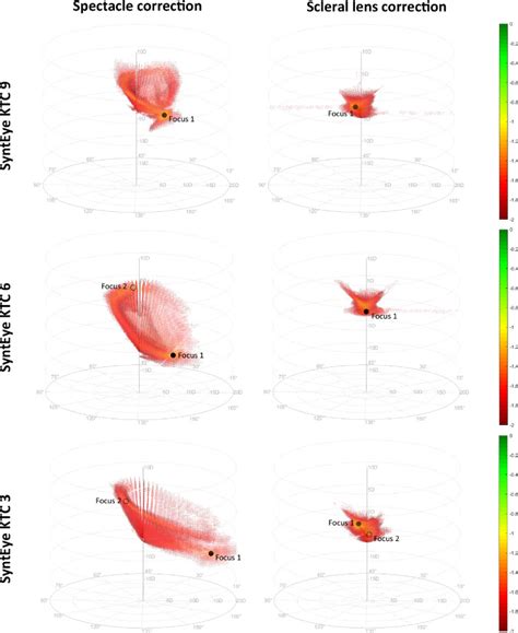 Modeling Refractive Correction Strategies In Keratoconus Pmc