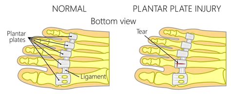 Capsulitis Of The Second Toe Treatment Taping Orthotics And Best Shoes
