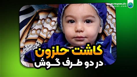 کاشت حلزون دختر بچه 2 ساله Youtube