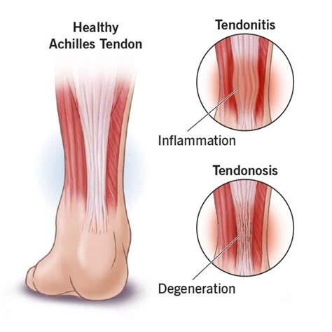 Achilles Tendonitis What You Need To Know