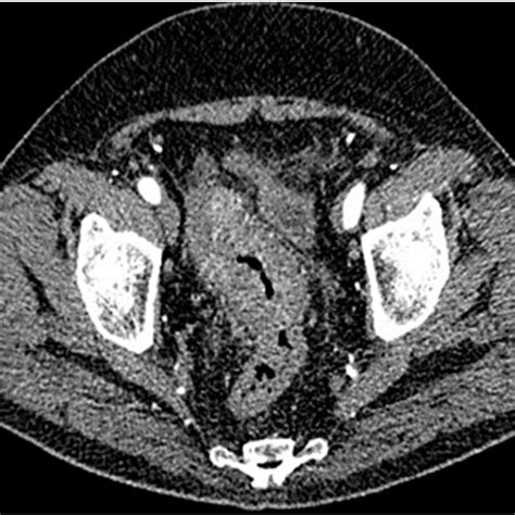 A C Endoscopy Images Showing The Rectosigmoid Junction With Linear Download Scientific