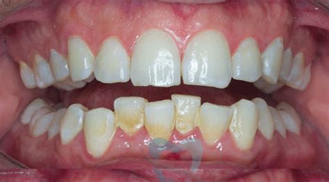 Tengo 1 Diente Chueco Y No Quiero Brackets