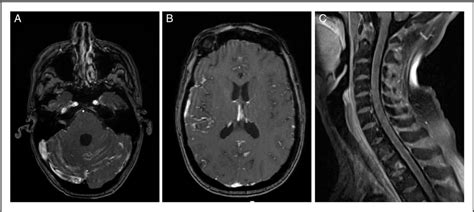 Figure 1 From Intrathecal Methotrexate Toxicity Resulting In Brain Death Due To Generalized