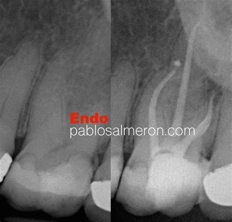 First Upper Molar Root Canal Phd Msc Dmd Pablo Salmeron
