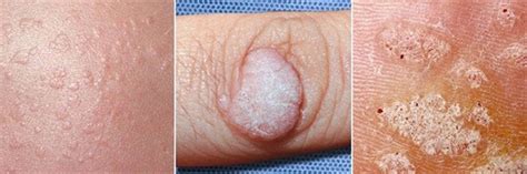 Do Genital Warts Spread