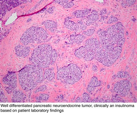Pathology Outlines Insulinoma Beta Cell Tumor
