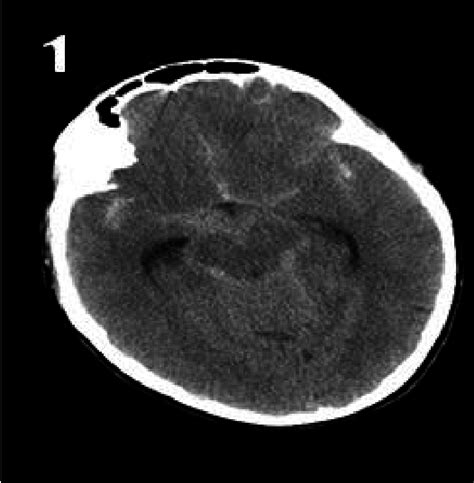 Ct Head Demonstrating Diffuse Sah Download Scientific Diagram