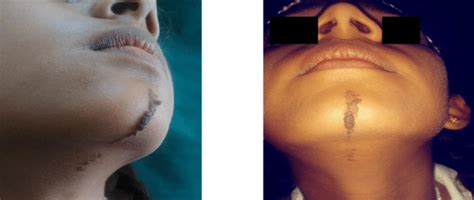 Linear Verrucous Epidermal Nevi Download Scientific Diagram