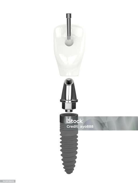 흰색 배경 위에 치과 임플란트의 3d 렌더링 치아 임플란트에 대한 스톡 사진 및 기타 이미지 치아 임플란트 나사 치관