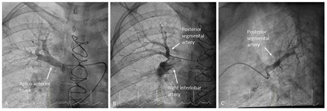 Pulmonary Artery Segmental Anatomy