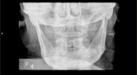 Radiography Of The Mandible Discrete Radiolucency In Bone Tissue On