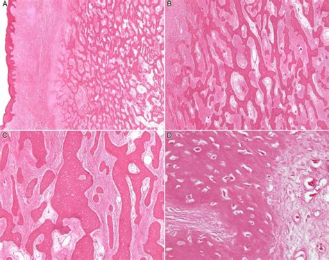 Maxillary Parosteal Osteosarcoma Additional Case Report And Literature