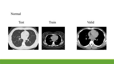Detection Of Lung Cancer From Ct Images Using Svm Classification And
