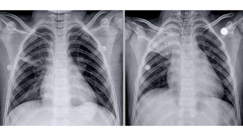 Atelectasis Causes Symptoms Diagnosis And Treatment
