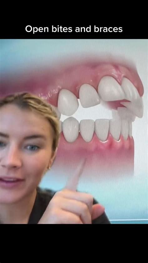 open bites braces [video] braces tips braces live lokai bracelet