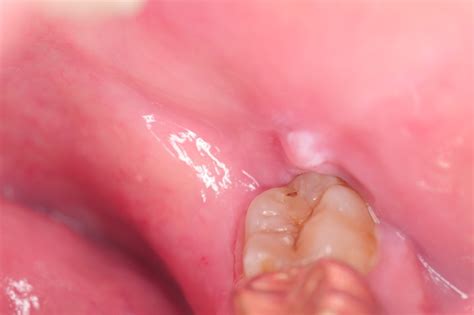 Swollen Mouth Ulcer Wisdom Tooth