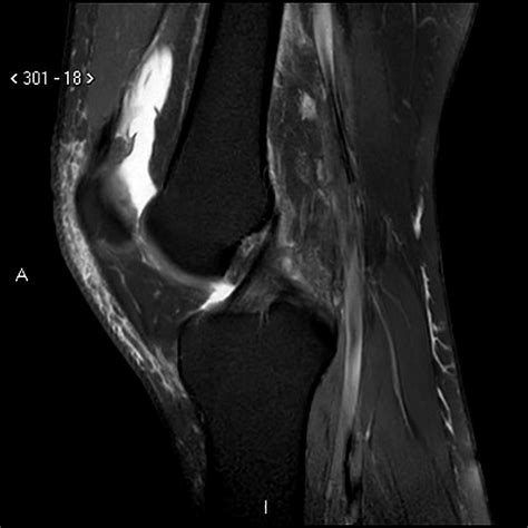 Quadriceps Tendon Mri The Radiology Assistant Non Meniscal Pathology