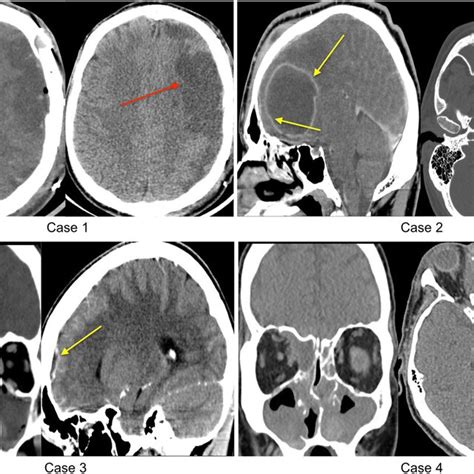 Case 1 Axial Ct Show Superior Sagittal Sinus Thrombosis Subdural