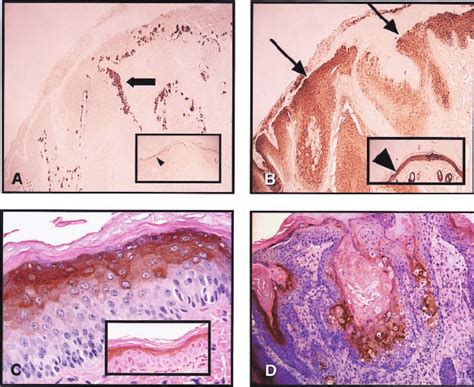 Immunohistochemical Staining Of Hyperplastic And Dysplastic Epithelium