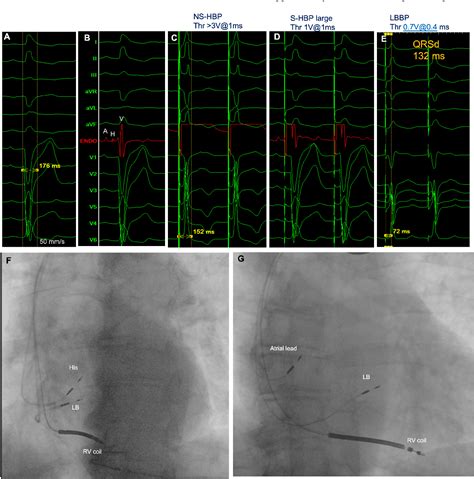 Figure 3 From Is Conduction System Pacing A Valuable Alternative To Biventricular Pacing For