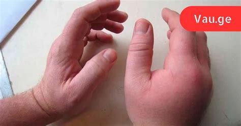 დაემშვიდობეთ სითხის შეკავებას შეშუპებას და ჭარბ წონას მხოლოდ 1 კვირაში ამ საოცარი რეცეპტით