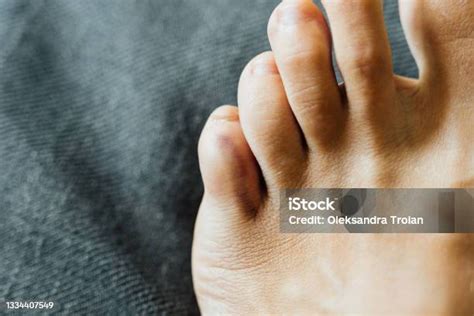 발 작은 손가락 부상 홈 사고 후 발가락 통증과 타박상이 거의 없습니다 팔란지 골절 맨발의 손톱은 건강합니다 가정 생활에 대한 스톡 사진 및 기타 이미지 Istock