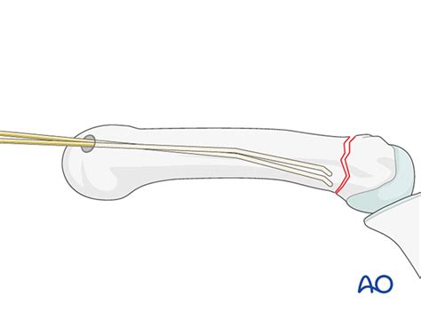 Intramedullary K Wire Fixation For Extraarticular Fracture Of The Distal End Segment