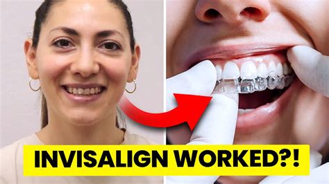 Does Invisalign Really Work Orthodontist Explains YouTube
