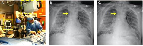 Bedside Tunneled Hemodialysis Catheter Placement The Surgeon