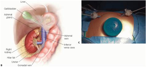 Laparoscopic Hand Assisted Donor Nephrectomy Plastic Surgery Key
