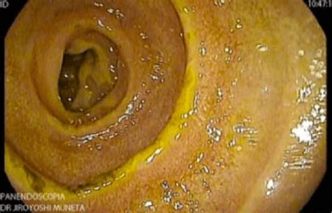 Endoscopic View Of The Interior Of The Duodenum Demonstrating The