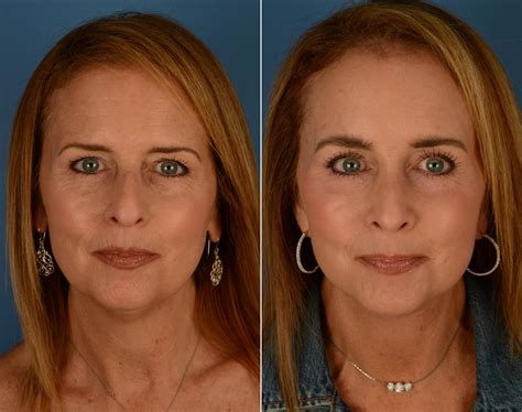 Lower Face Lift What Age At Shelley Morgan Blog
