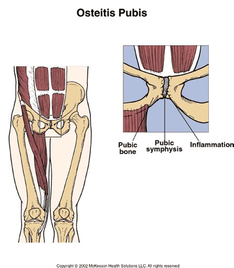 Osteitis Pubis Pubic Symphysis Dysfunction Treatment And Causes