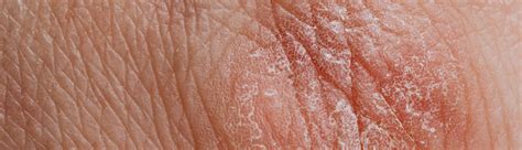 3d Atopic Dermatitis Model Non Artificial Human In Vitro Skin Tests Alcyomics