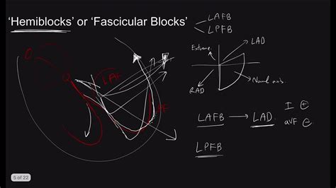 Bundle Branch Block The Series [part 2 Advanced Hemi Bifascicular Blocks] I The Pacemaker Youtube