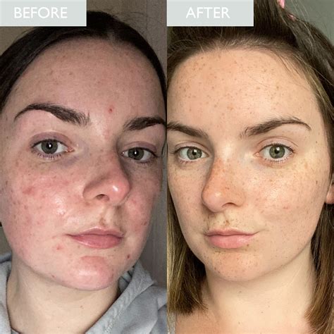 Acne Before And After Zinc