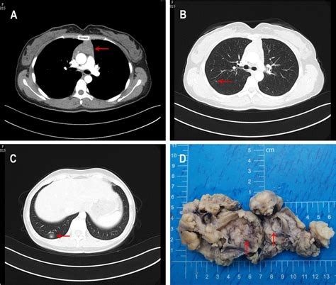 Thymus Gland Ct Scan At James Fontanez Blog
