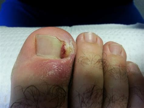 Pyogenic Granuloma Nail