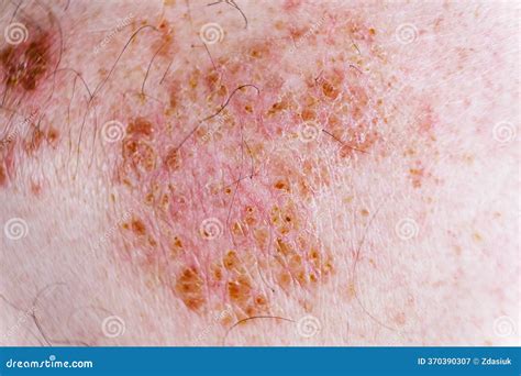 Skin Lesion Symptom In Shingles Or Herpes Zoster In Person Viral Disease Varicella Virus